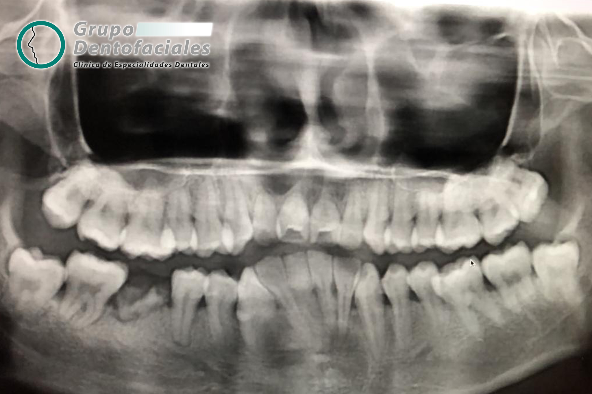 Radiografía panorámica muelas del juicio
